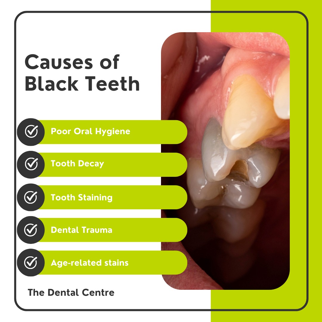Black Teeth: Symptoms, Causes and Treatment - The Dental Centre
